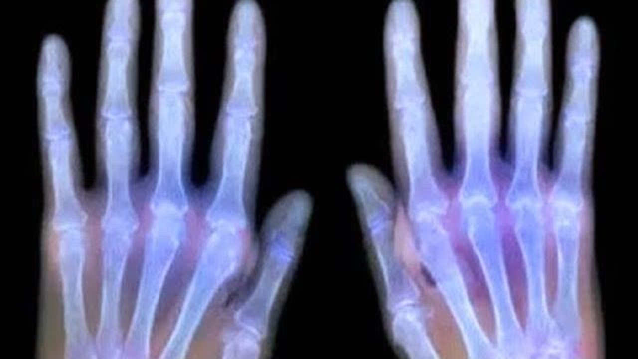 MRI Showing Cracking Of Knuckles And Joints - YouTube