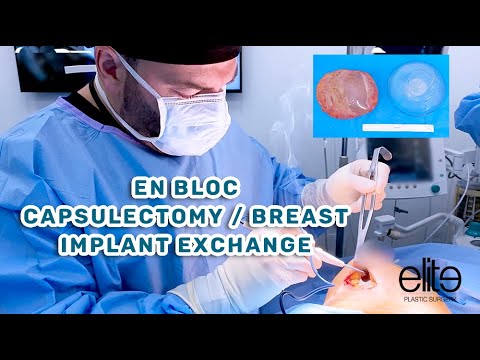 En Bloc Capsulectomy | Breast Implant Exchange - YouTube
