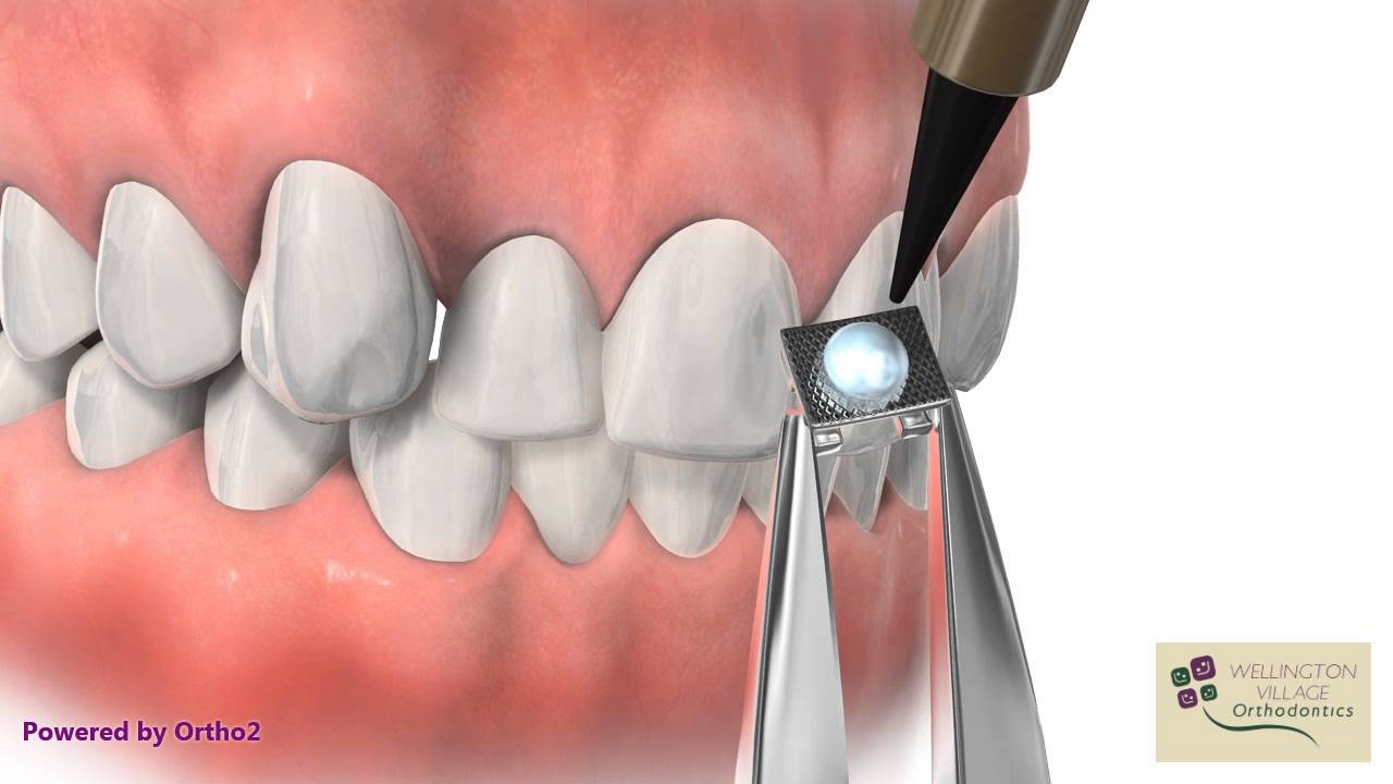 Direct Bonding - YouTube