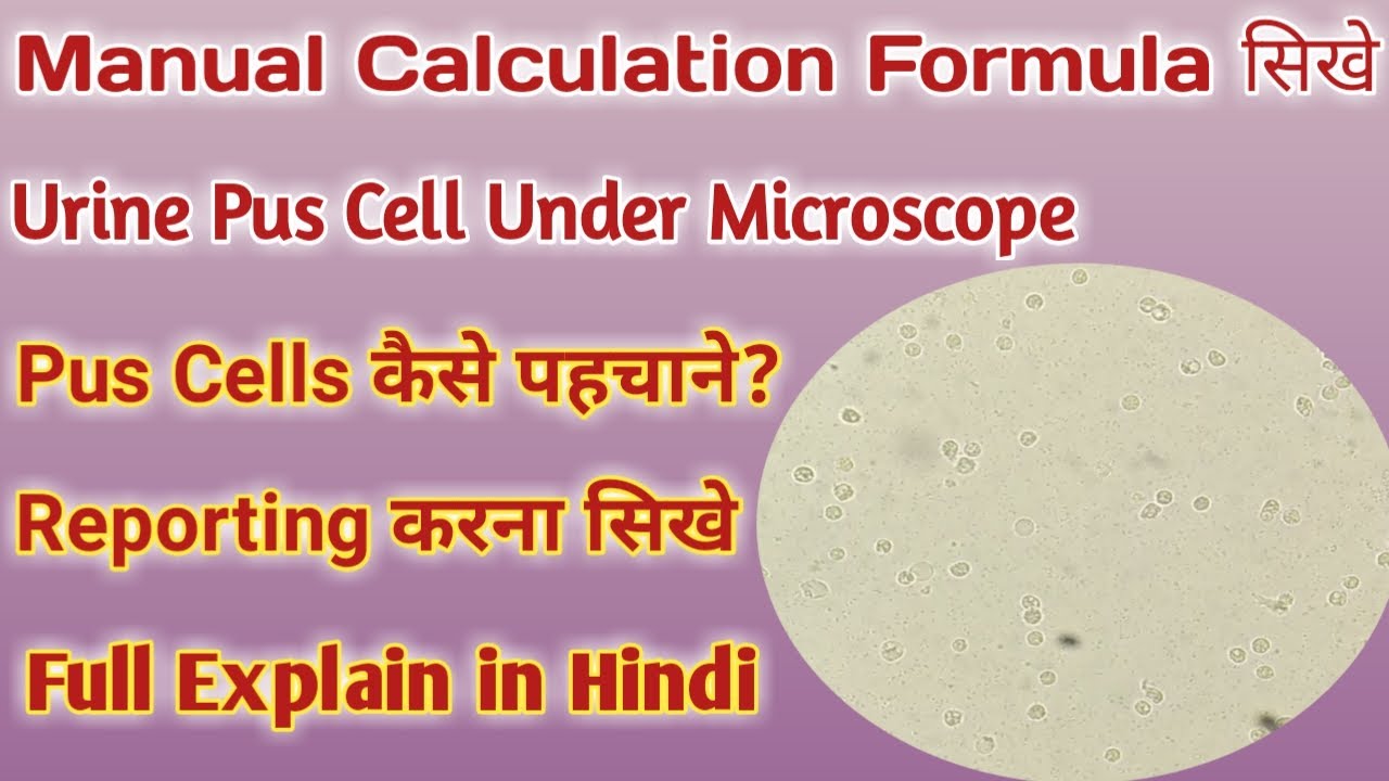 Pus Cells Under Microscope Pus Cells In Urine How To Identify Urine pus-cells-under-microscope-pus-cells-in-urine-how-to-identify-urine
