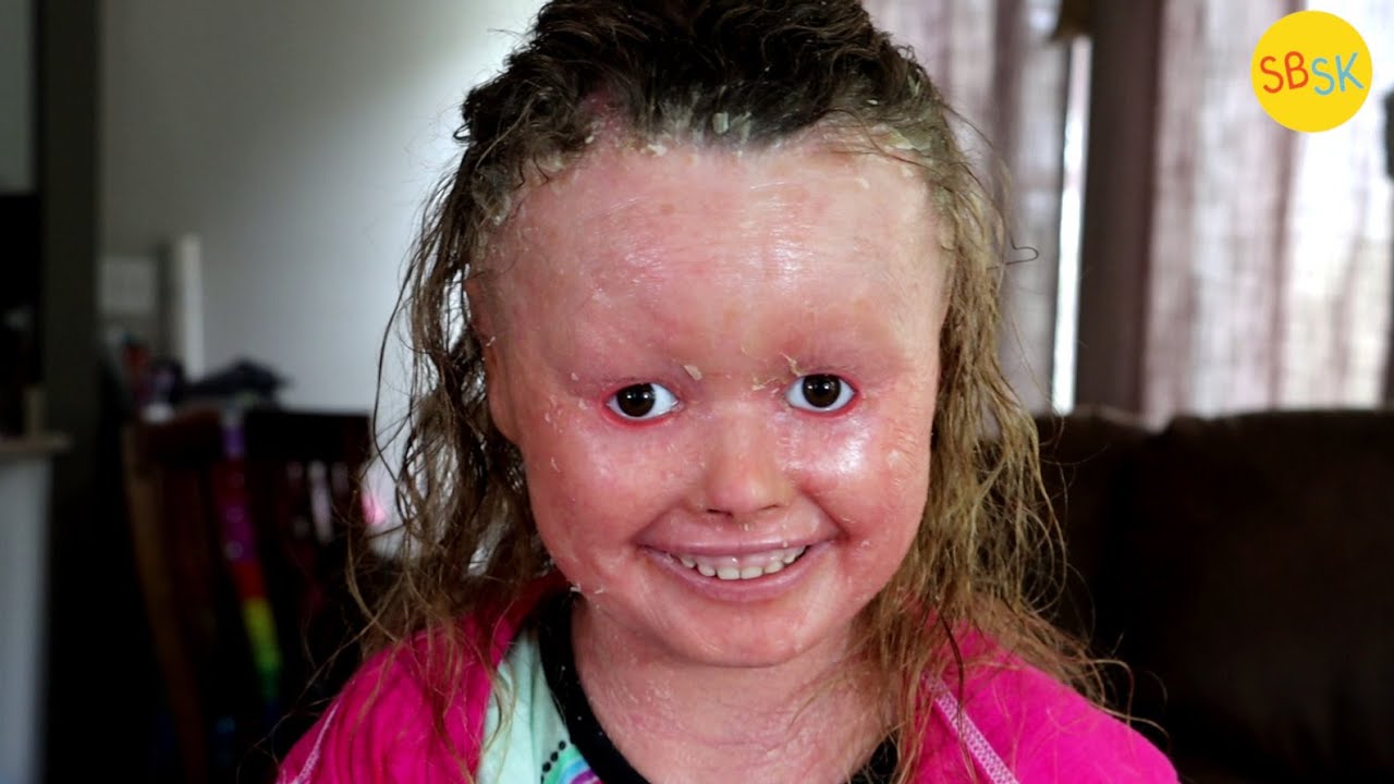 Living With Harlequin Ichthyosis Skin That Grows 10x Too Fast Youtube
