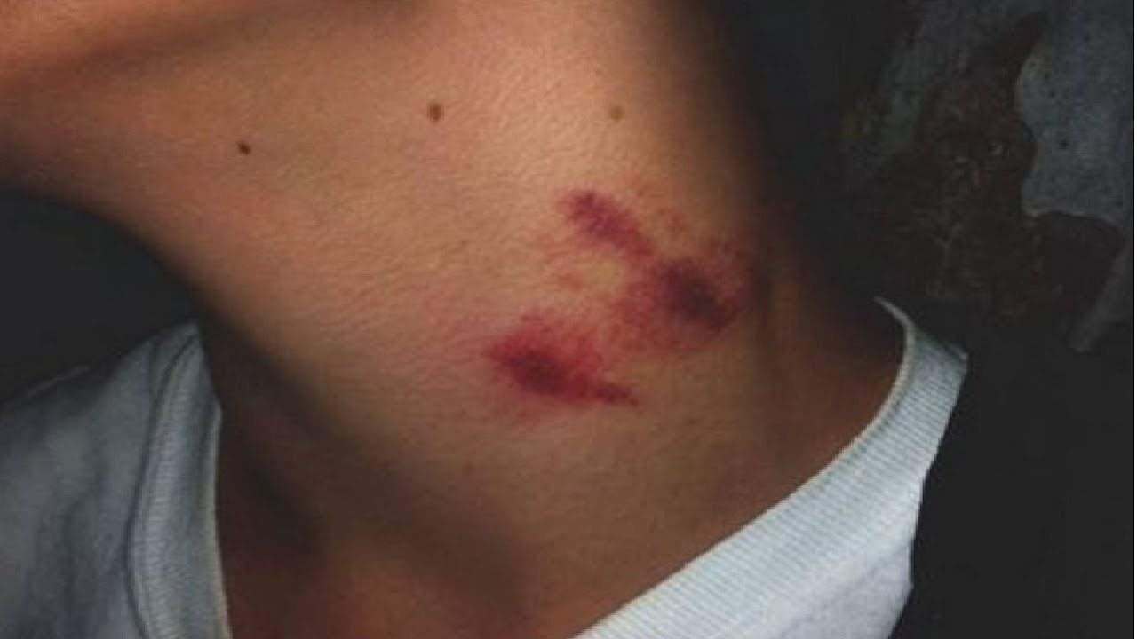 how to get rid of a hickey in 2 minutes - easiest way to get rid of a ...