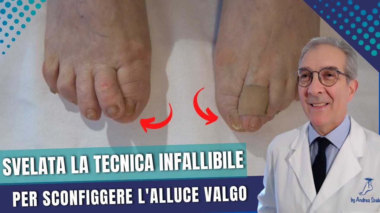 Alluce valgo: diagnosi e intervento | Svelata la Tecnica Infallibile ...