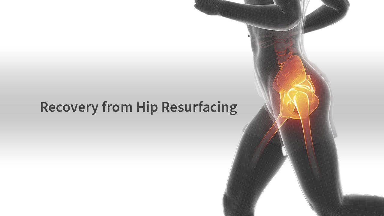 Recovery from Hip Resurfacing - YouTube