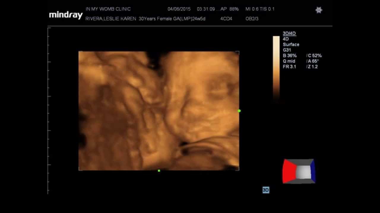 Ultrasound of Baby Kaziel Lexee smiling - YouTube