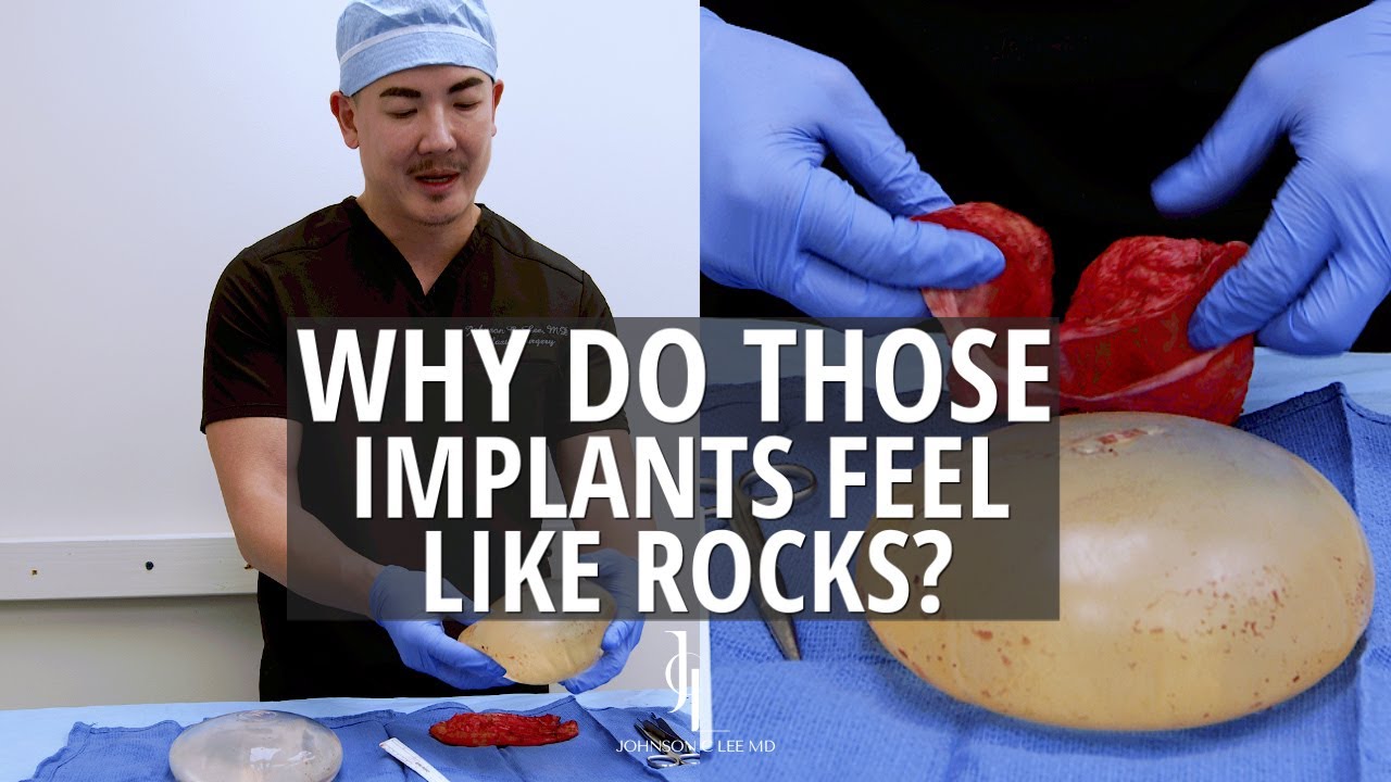 Capsulectomy | Hard Implants | Breast Implant Irregularities - YouTube
