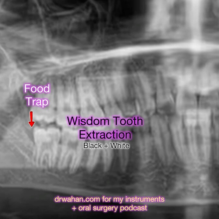 Tissue Impaction Wisdom Tooth Extraction Video - YouTube