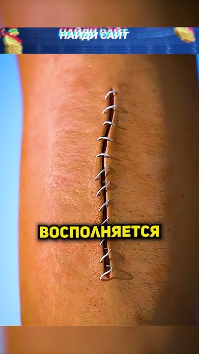 Вот как защивают рану. 😨 - YouTube