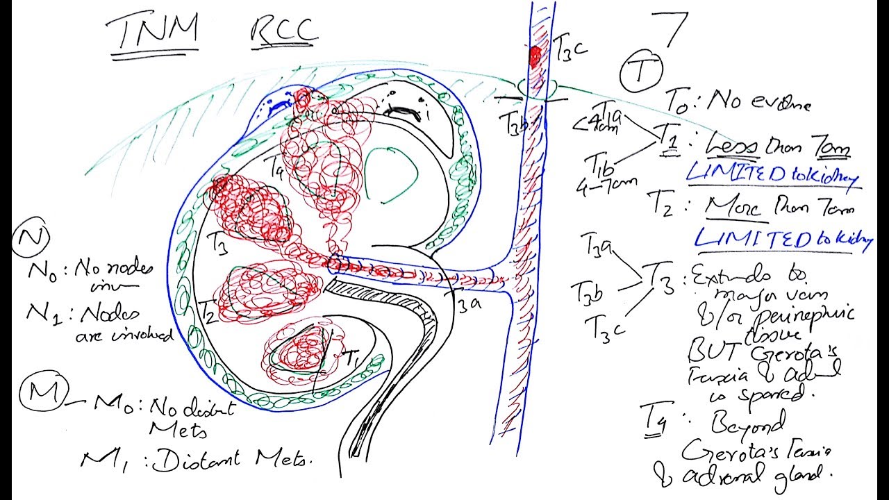 Renal Cell Carcinoma Staging