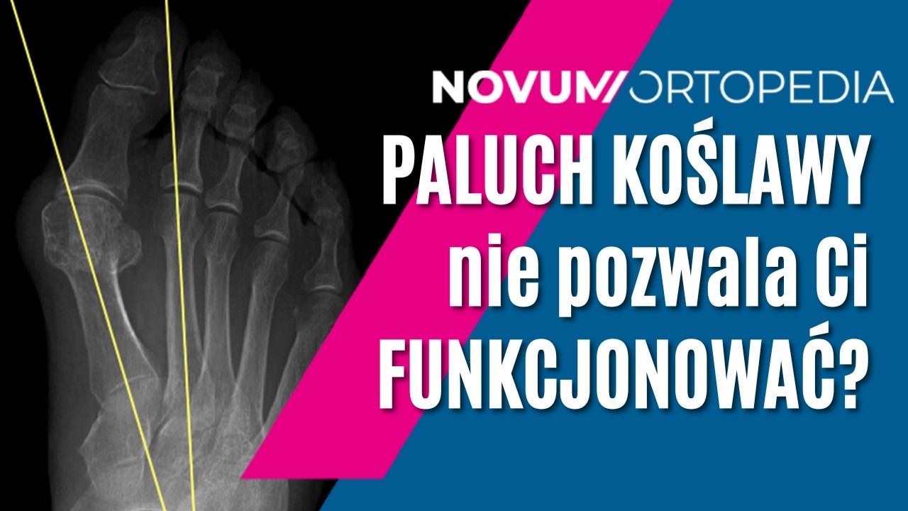 Korekcja palucha koślawego wg LAPIDUSA | Novum Ortopedia - YouTube