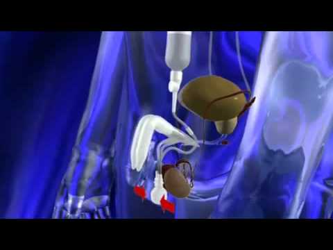 Penile Prosthetic Surgery Explained - YouTube