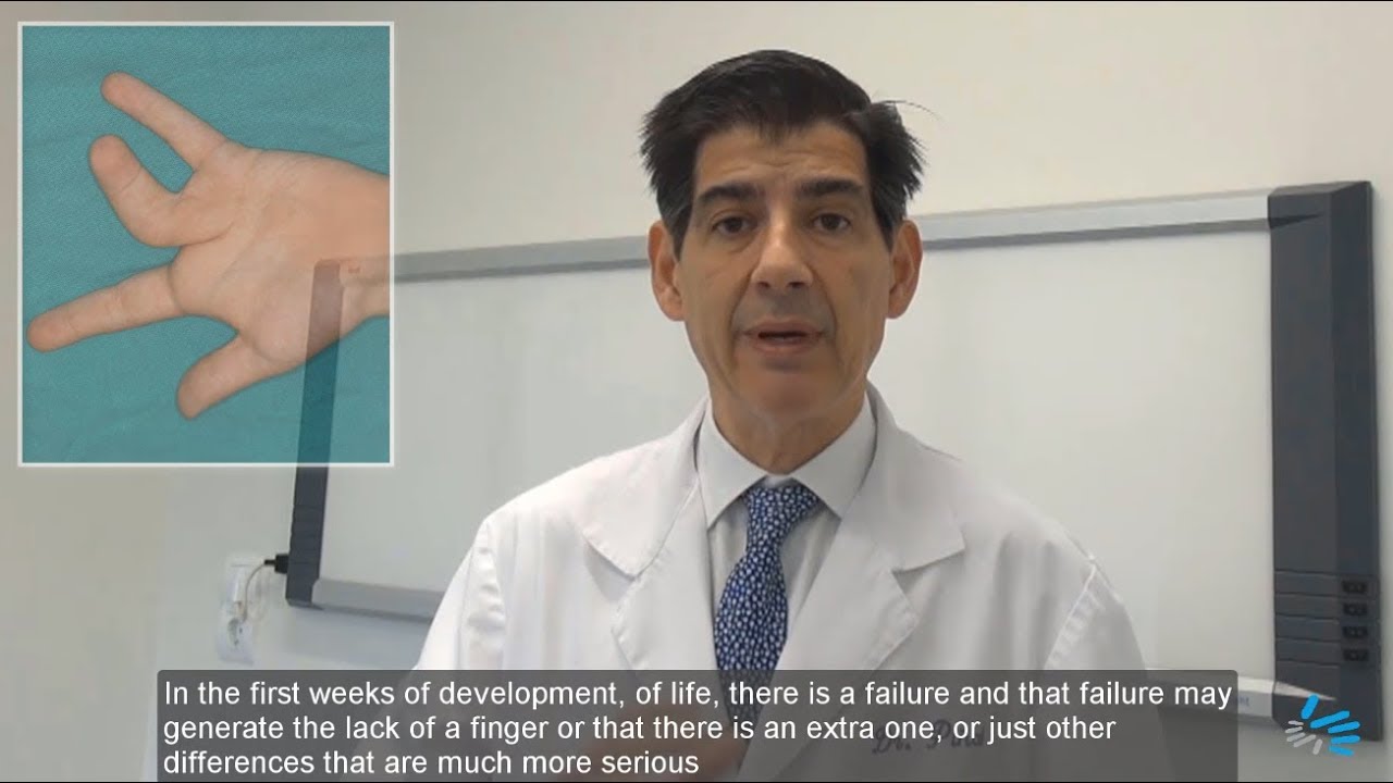 Malformaciones congénitas de la mano: análisis y respuestas quirúrgicas ...