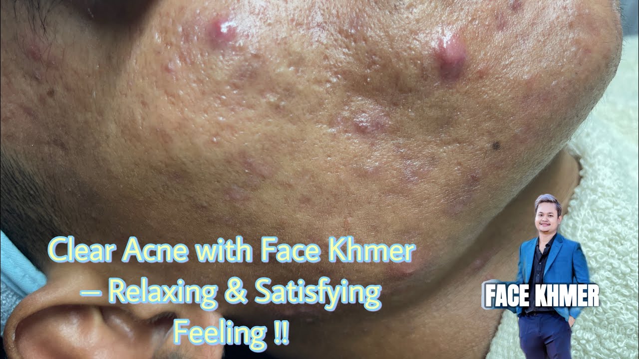 Clear Acne with Face Khmer (Part #37) – Relaxing & Satisfying Feeling # ...