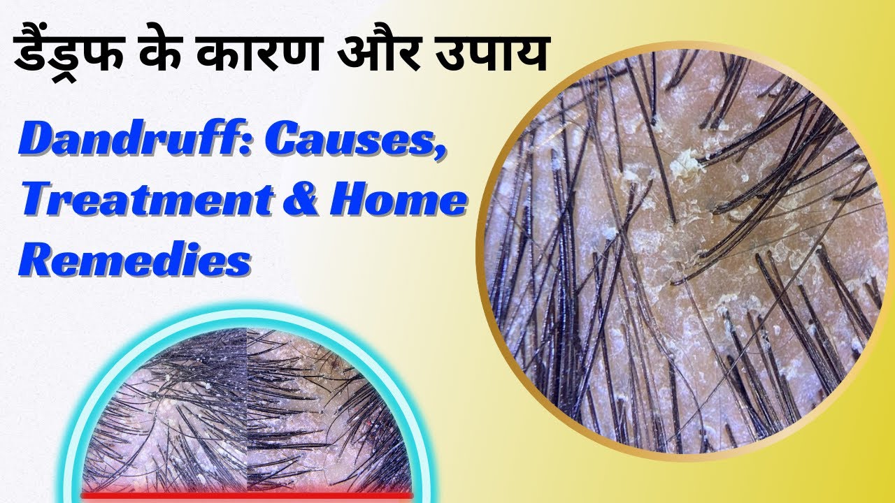 Dandruff: Causes, Treatment & Home Remedies | Dr. Uttam Kumar Lenka- MD ...