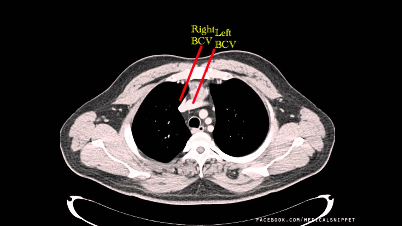 Major Thoracic Vessels | Venous - YouTube