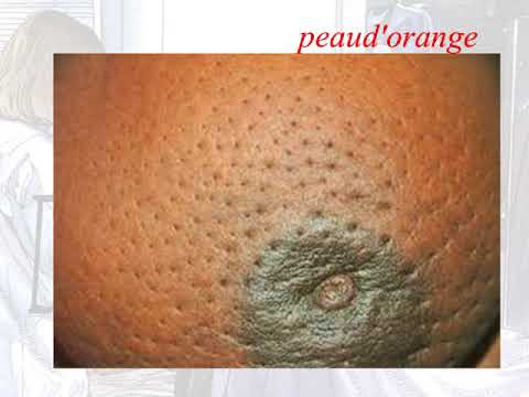 Clinical Breast Examination - YouTube