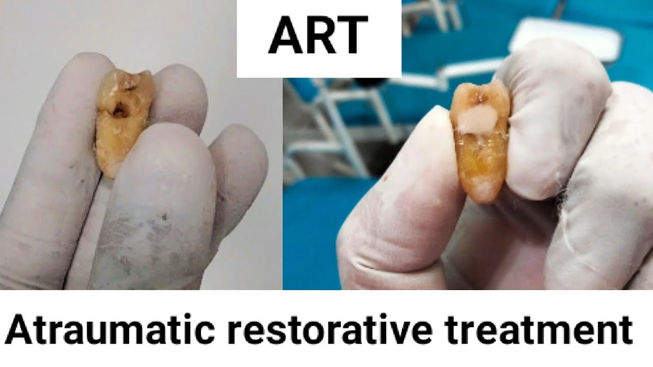 Atraumatic restorative treatment session// community dentistry - YouTube