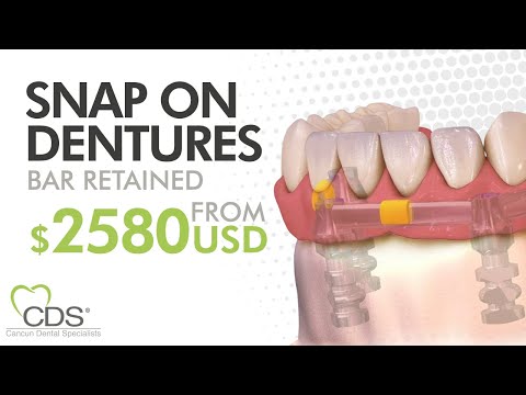 What Is a Bar Retained For Snap On Dentures in Mexico? |  | Cancun Dental Specialists