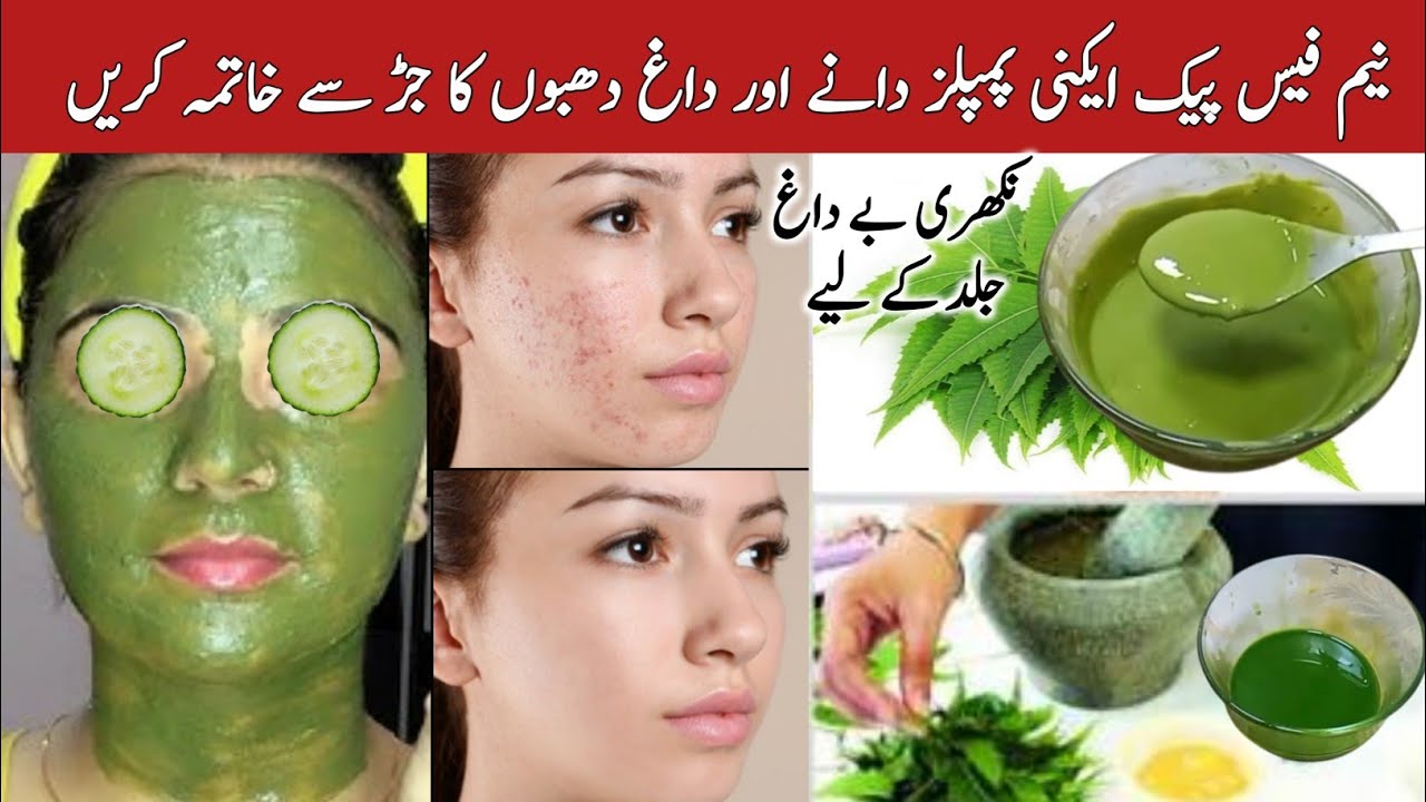 Neem Face Pack For Acne & Pimples|Remove Pimples & Body Acne ...