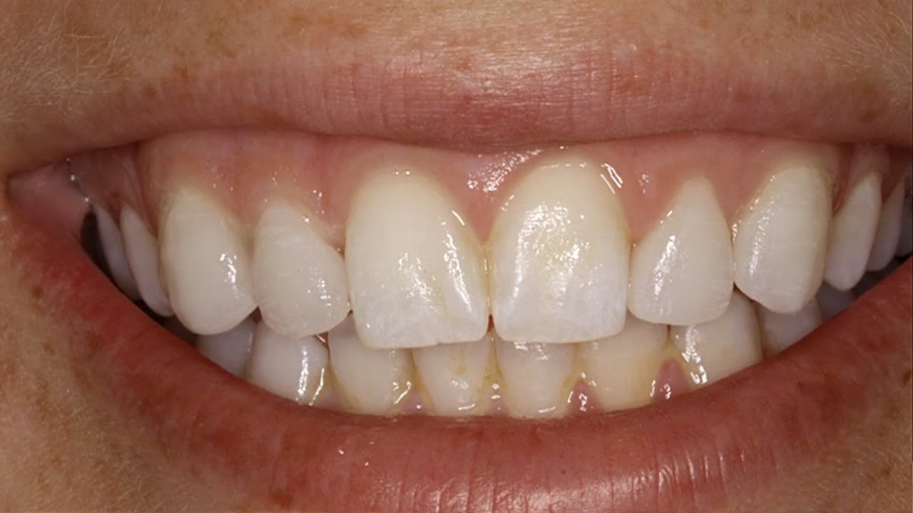 Less Invasive Cosmetic Dentistry - Howard M. Steinberg, DMD - YouTube