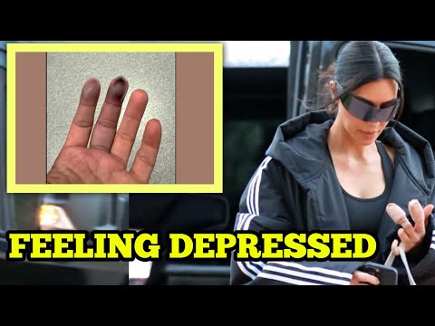 Kim Kardashian involved in accident that cause the loss of two of her fingers