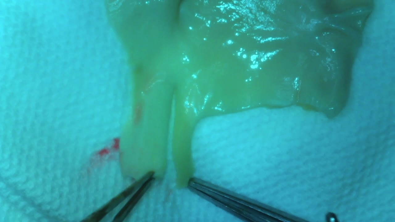 One-Stage Midline Unifocalization With Complete Repair of Pulmonary ...