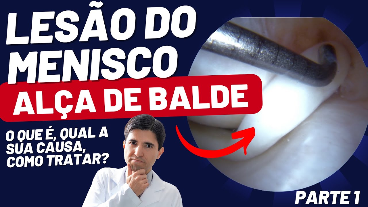 LESAO EM ALÇA DE BALDE DO MENISCO, O QUE É, QUAL A SUA CAUSA, COMO ...