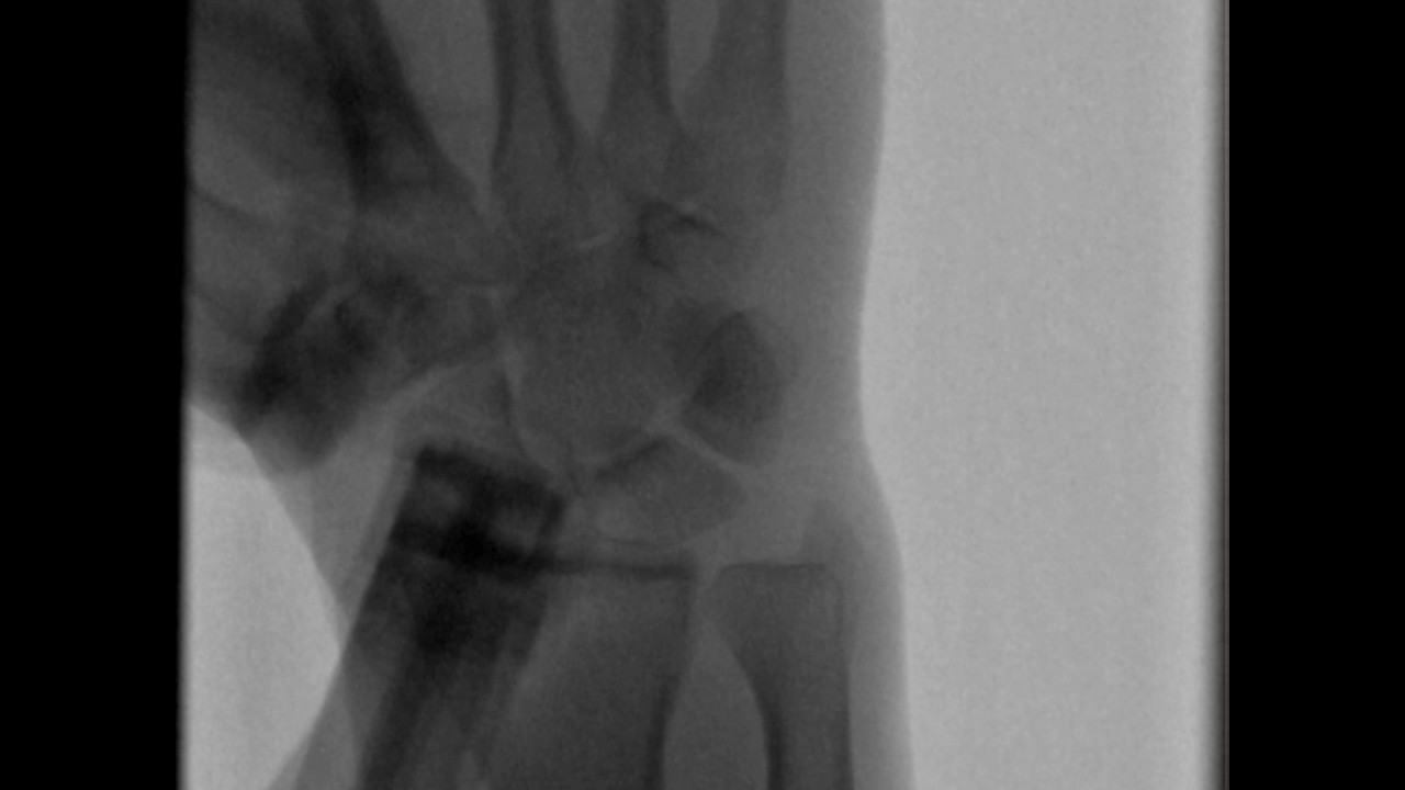 Fluoroscopy Isolated midcarpal joint motion with stabilization of ...