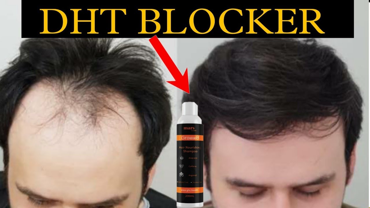 Best DHT Blocker Shampoo For Men|Shampoo For Hair Loss | - YouTube