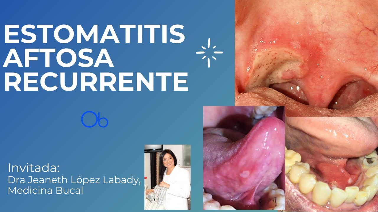 Estomatitis aftosa recurrente 👄 👅 con Dra Jeaneth López Labady - YouTube