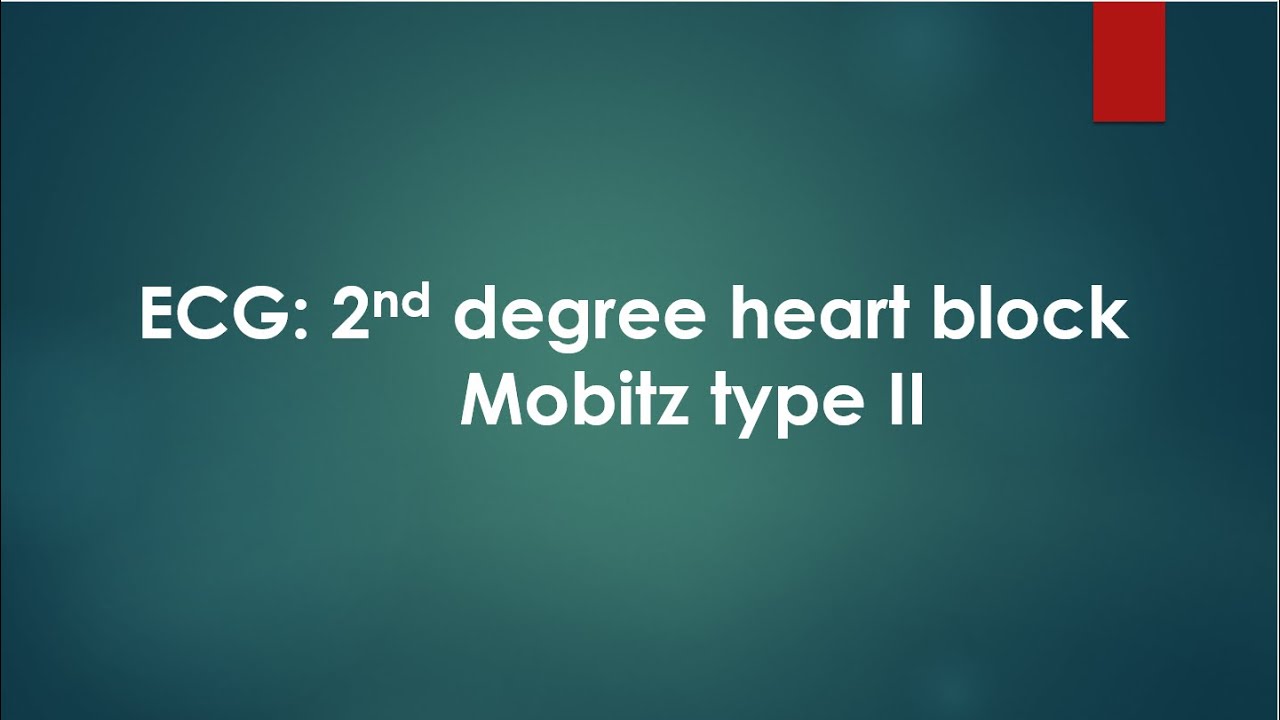 ECG 2nd degree heart block Mobitz type II - YouTube