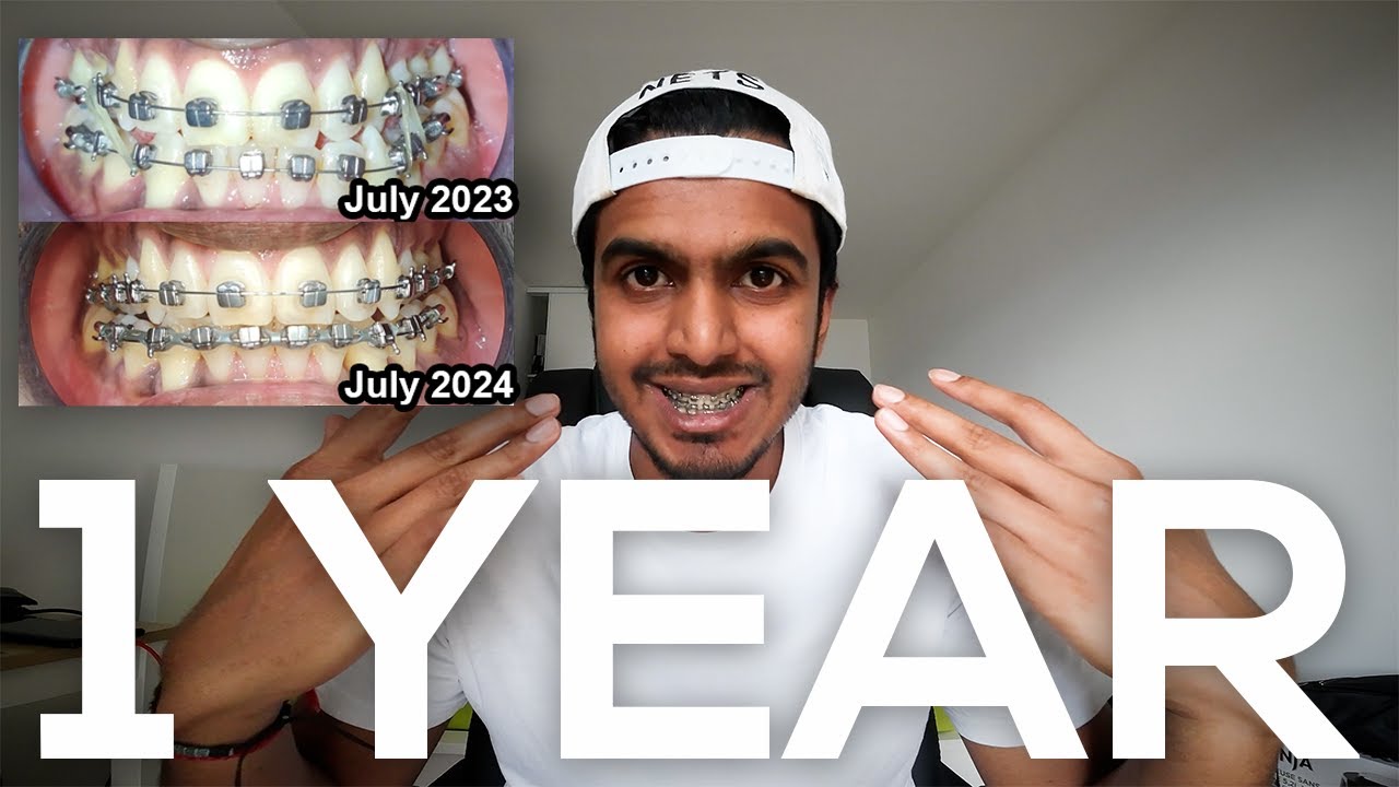 BRACES JOURNEY - 1 Year Transformation - YouTube