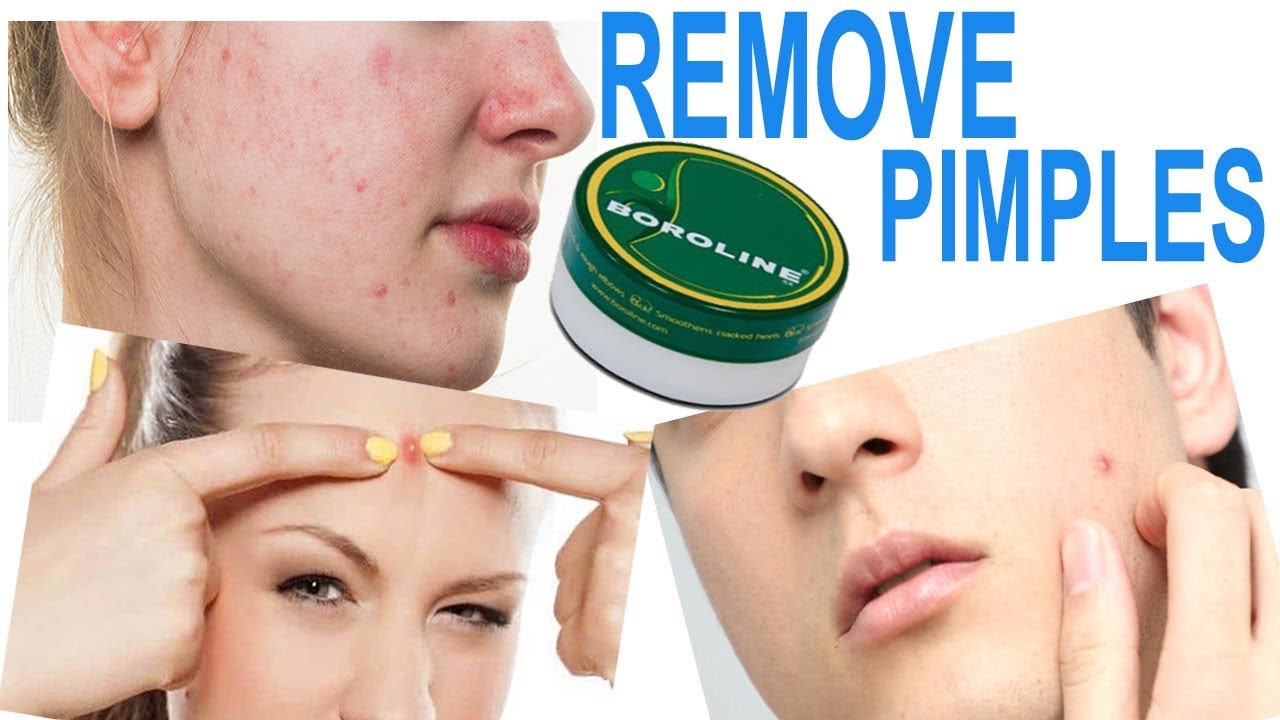 How To Remove Pimples And Dark Spots Overnight YouTube how-to-remove-pimples-and-dark-spots-overnight-youtube