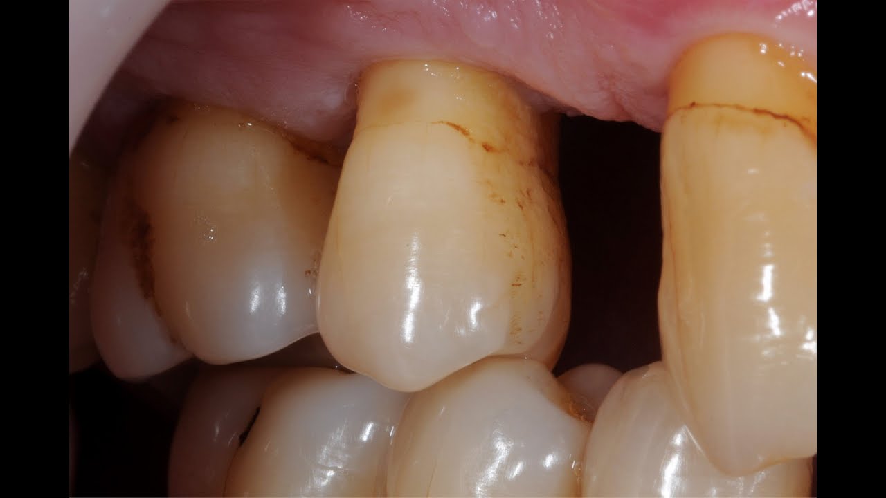 Tooth preparation: Malposed teeth - YouTube