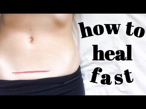 WHAT TO EXPECT AFTER YOUR C-SECTION BIRTH + MY 7 MONTH C-SECTION SCAR ...