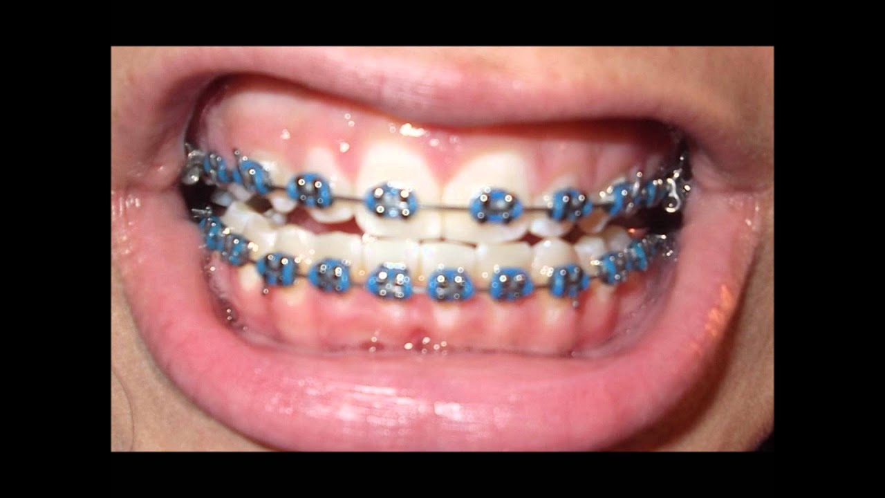 Brackets 22° Mes - YouTube