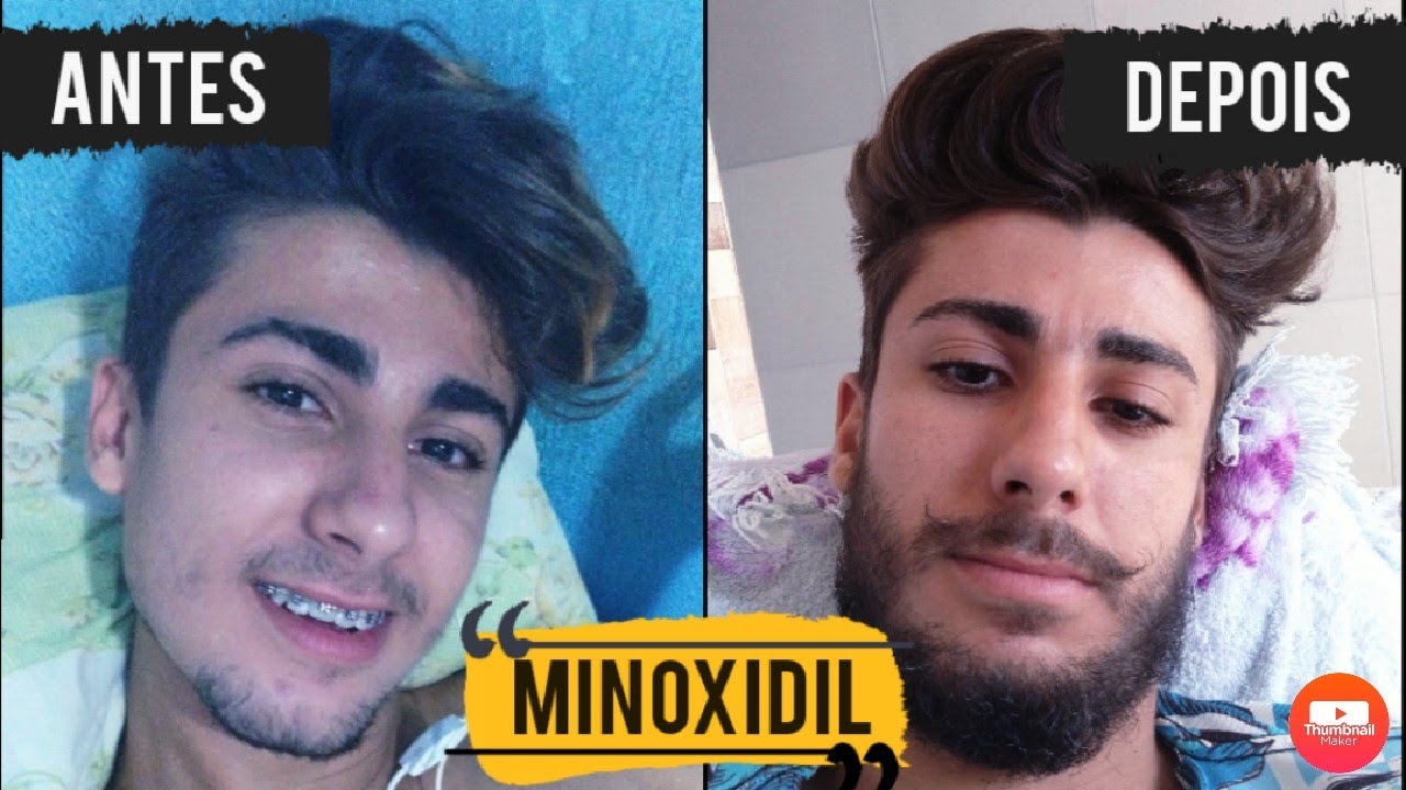 6 meses usando minoxidil pant ( bigode do alok ) #minoxidil # ...