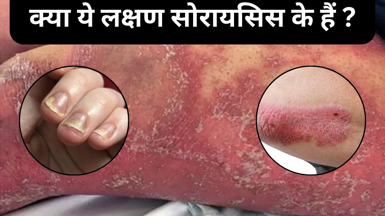 सोरायसिस के शुरुआती लक्षण early symptoms of psoriasis - YouTube