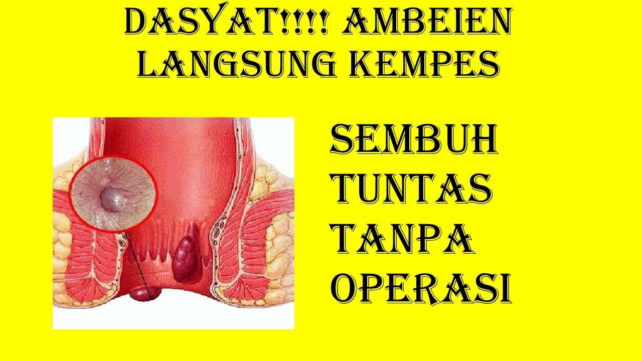 Wasir | Benjolan Yang Sangat Sensitif Atau Nyeri Pada Sekitar Anus ...