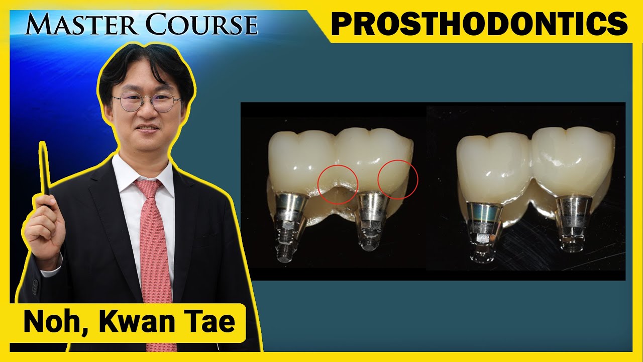 [Master Course Season2 -PROSTHODONTICS] Crown - Related Complications ...
