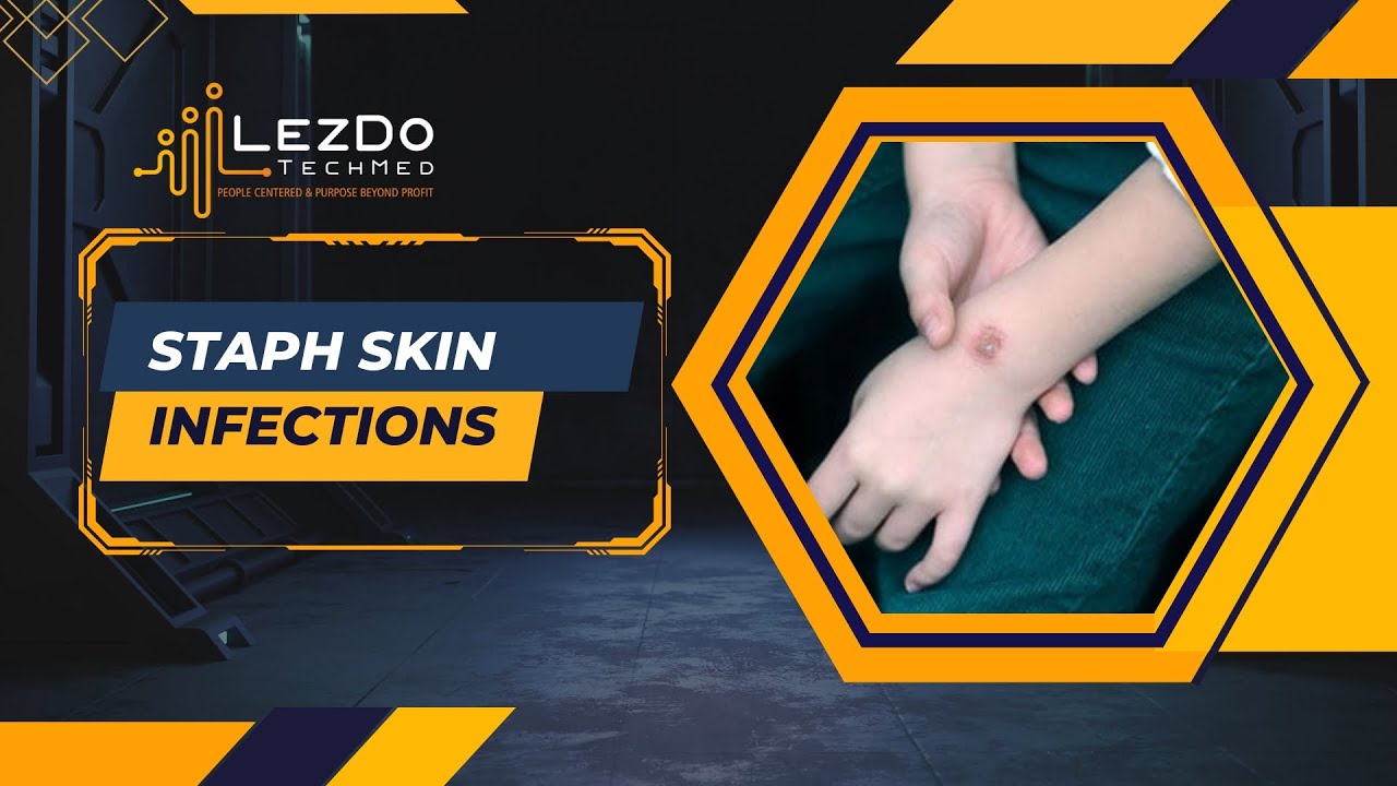 Staph Skin Infections - YouTube
