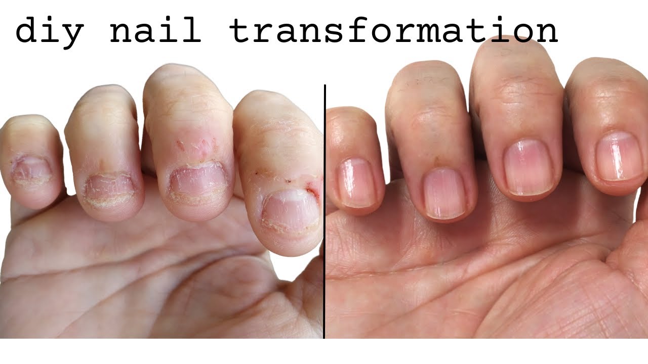 From bitten to beautiful (and healthy!) nails! - YouTube
