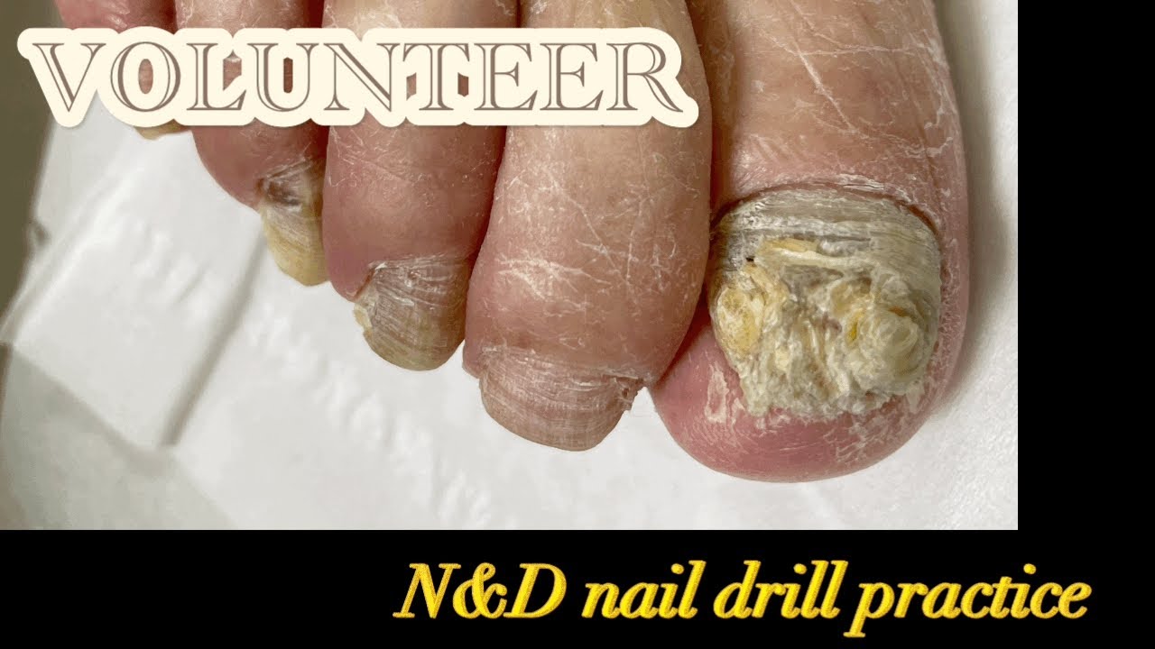 nail /toenail /nailcare /athlete’s foot /practice /nail&drill - YouTube