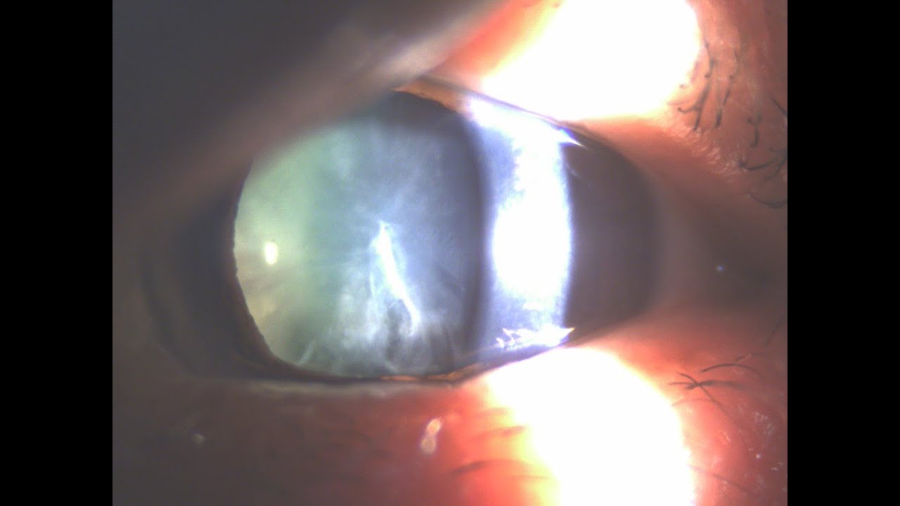 routine cataract surgery, phaco chop hoya IOL - YouTube