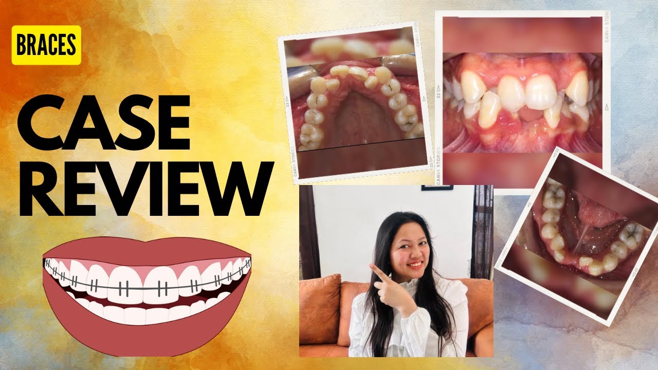Braces for everyone | Orthodontic case Review 1 | before and present ...