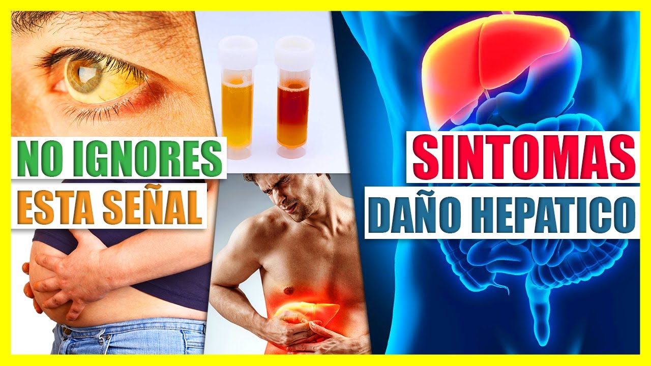 Sintomas Del Daño Hepatico - Ictericia, Insuficiencia Hepática, Signos ...