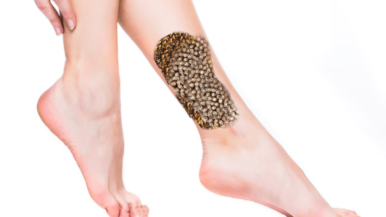 Injured Leg Fast Treatment - YouTube