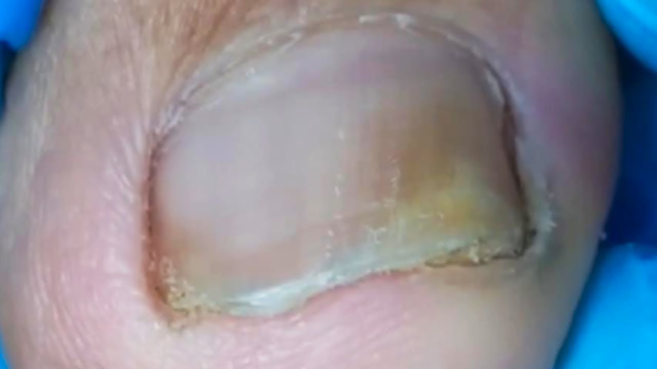 Amazing Large Ingrown Nail, Trimmed Cleanly【Crazy pedicure room】 - YouTube