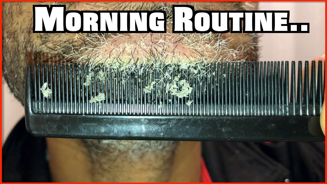 Beard Flakes Morning Routine | DANDRUFF FLAKES | SEBORRHEIC DERMATITIS ...