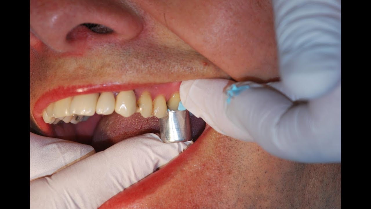 Ny fyllingskteknikk med HyperFIL - YouTube